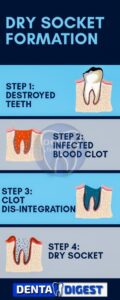 DRY SOCKET | EVERYTHING YOU NEED TO KNOW | Dentadigest