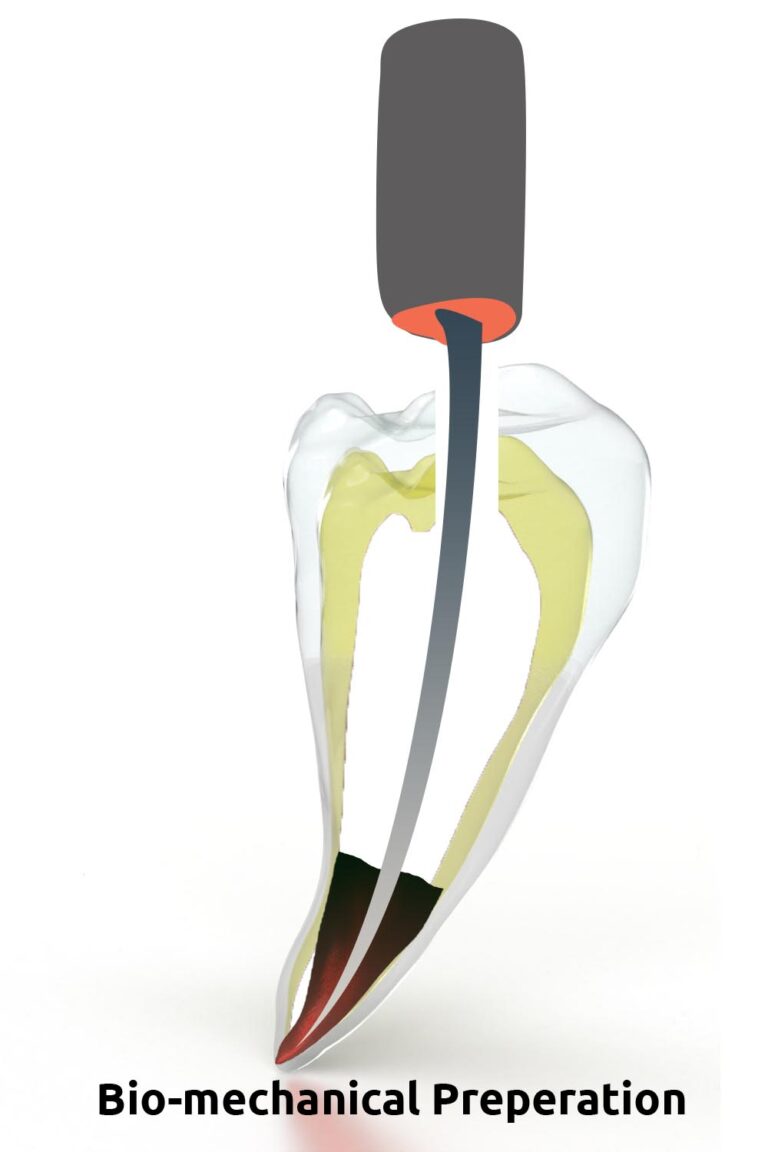 Root Canal Treatment. Everything You Need To Know | Dentadigest