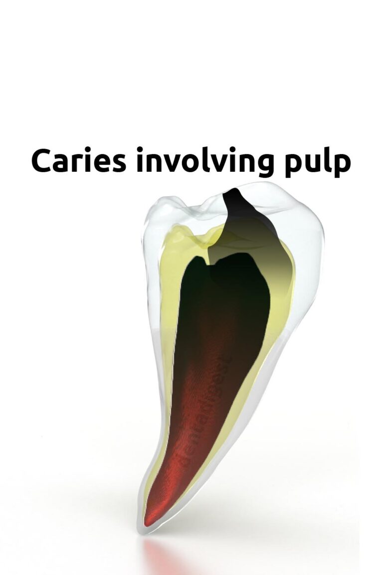 Root Canal Treatment. Everything You Need To Know | Dentadigest
