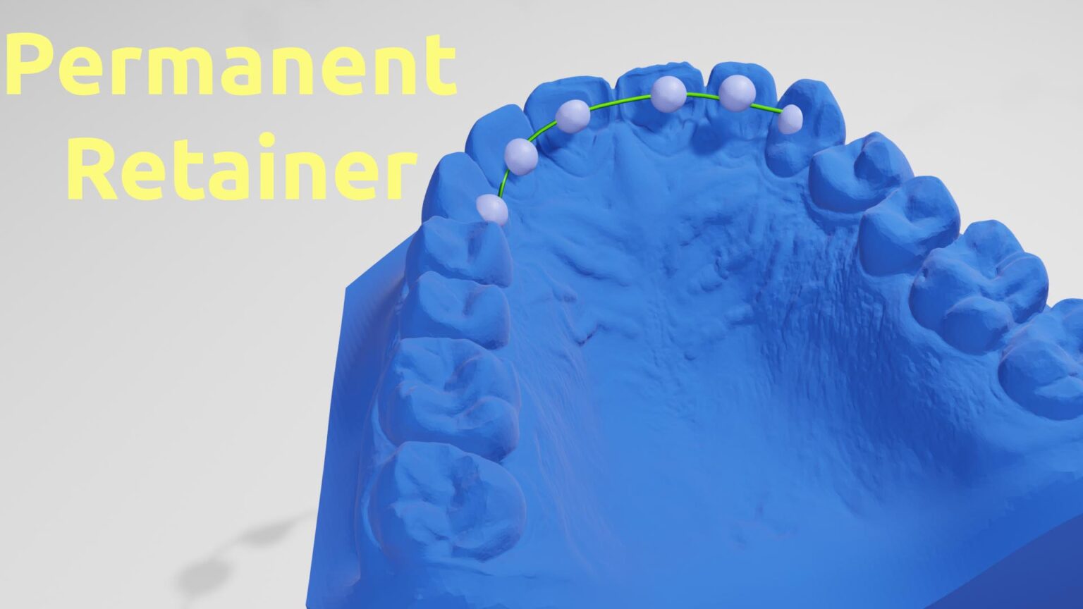 IS PERMANENT RETAINER THE RIGHT CHOICE AFTER BRACES? | Dentadigest