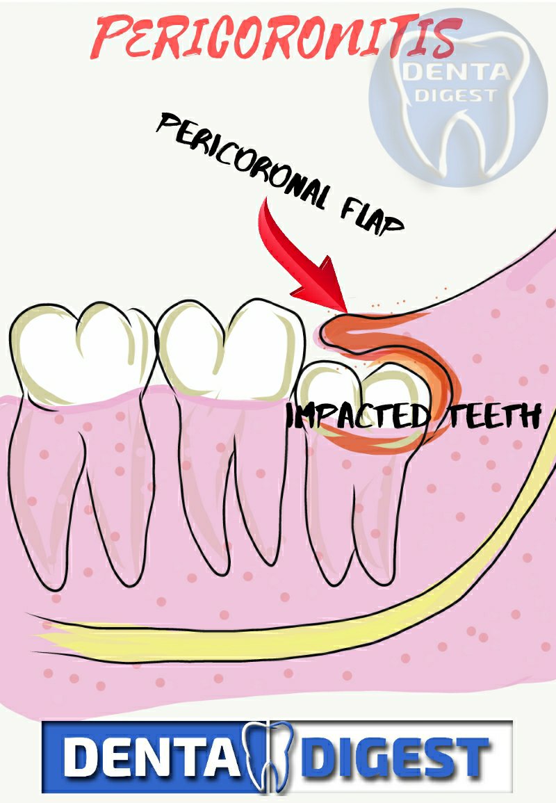 WISDOM TOOTH INFECTION. A PATIENT’S GUIDE TO MANAGE PERICORONITIS ...