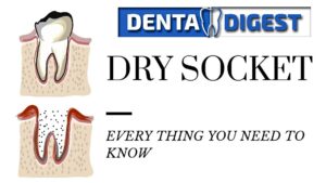 DRY SOCKET | EVERYTHING YOU NEED TO KNOW | Dentadigest
