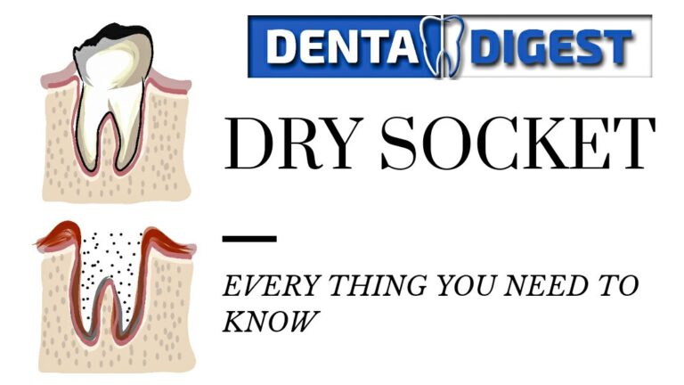 DRY SOCKET | EVERYTHING YOU NEED TO KNOW | Dentadigest